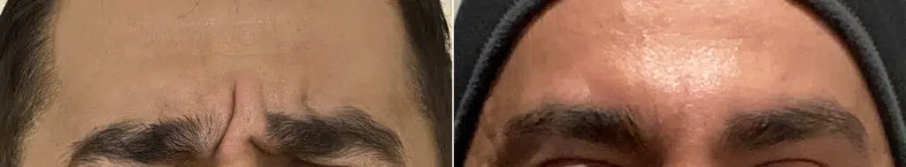 Botox Timeline from Immediate to 6-Month Results | Irvine, CA