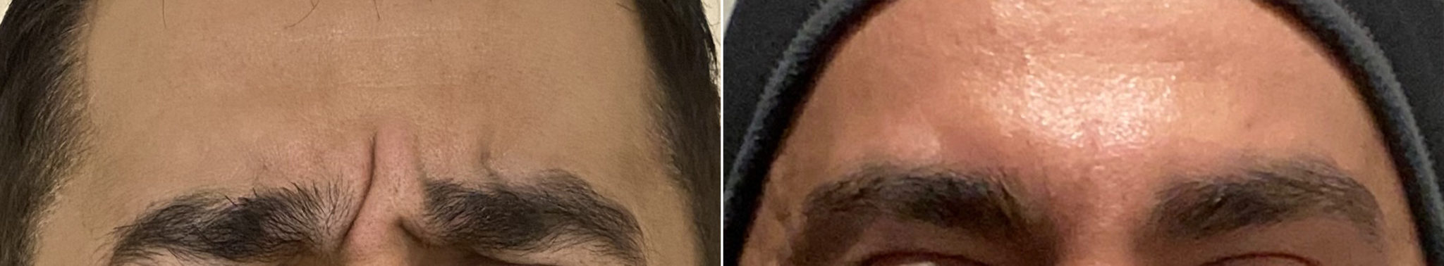 Botox Timeline from Immediate to 6-Month Results | Irvine, CA