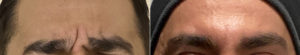 Botox Timeline from Immediate to 6-Month Results | Irvine, CA