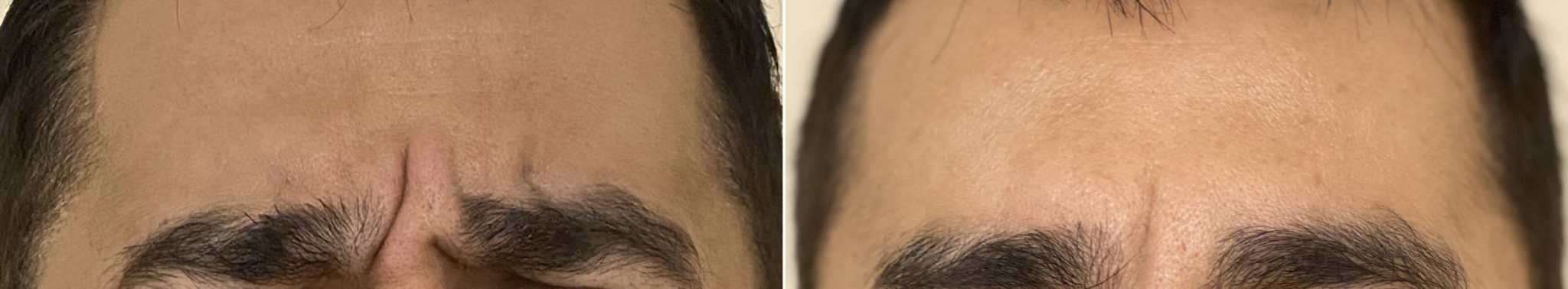 Botox Timeline from Immediate to 6-Month Results | Irvine, CA