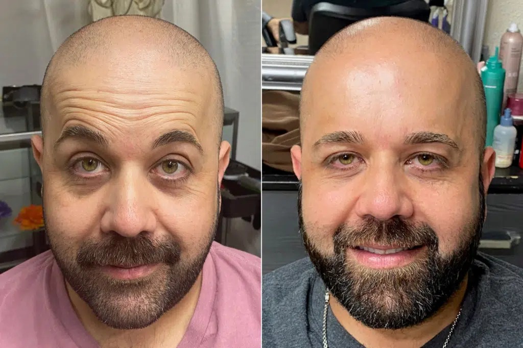 How Long Does Botox Swelling Last? | Botox Recovery Timeline