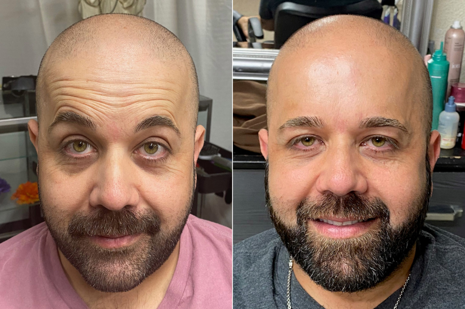 How Long Does Botox Swelling Last? | Botox Recovery Timeline