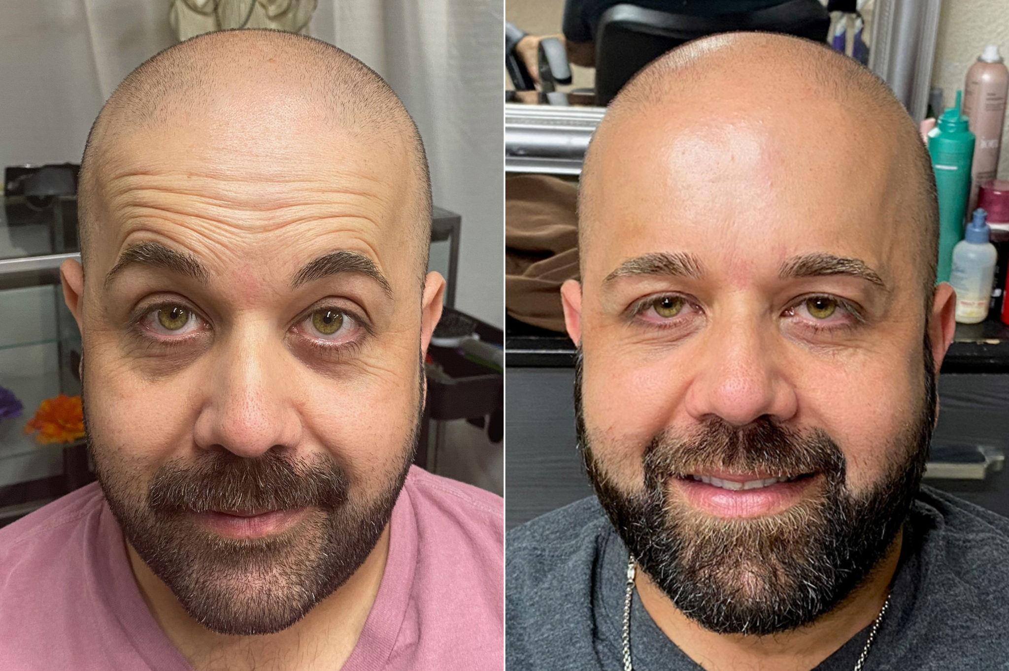 Why Botox is So Popular? Benefits and Uses | Irvine, CA