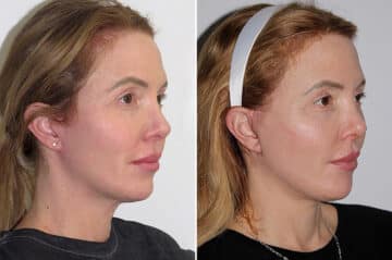 Deep Plane Facelift vs Mini Facelift: Key Differences