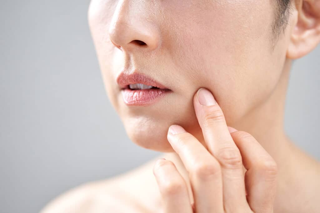 Expert Botox Treatments for Lifting Lip Corners | Irvine, CA