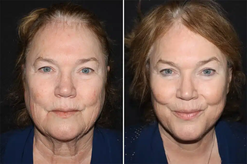 Saggy Face After Weight Loss | Causes & Treatment Options